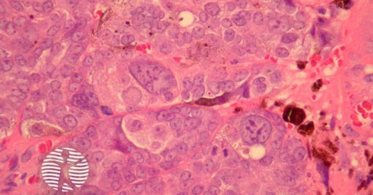 Melanocytic matricoma pathology image