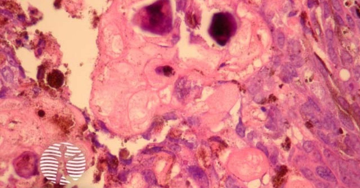 Melanocytic matricoma pathology image