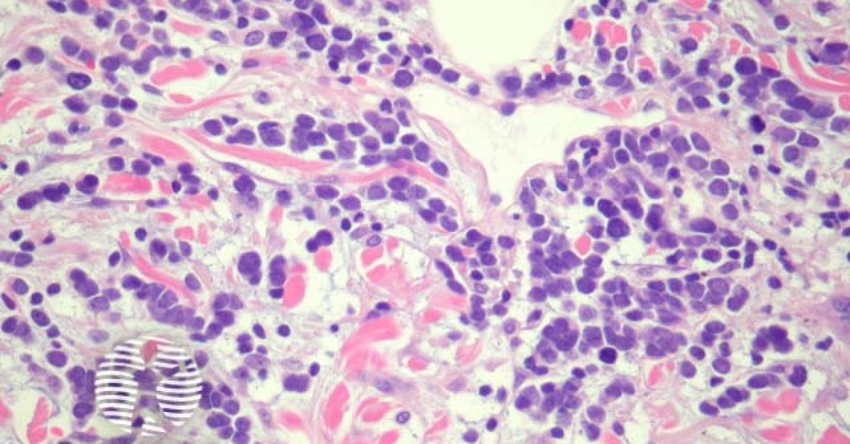 Merkel cell carcinoma pathology image