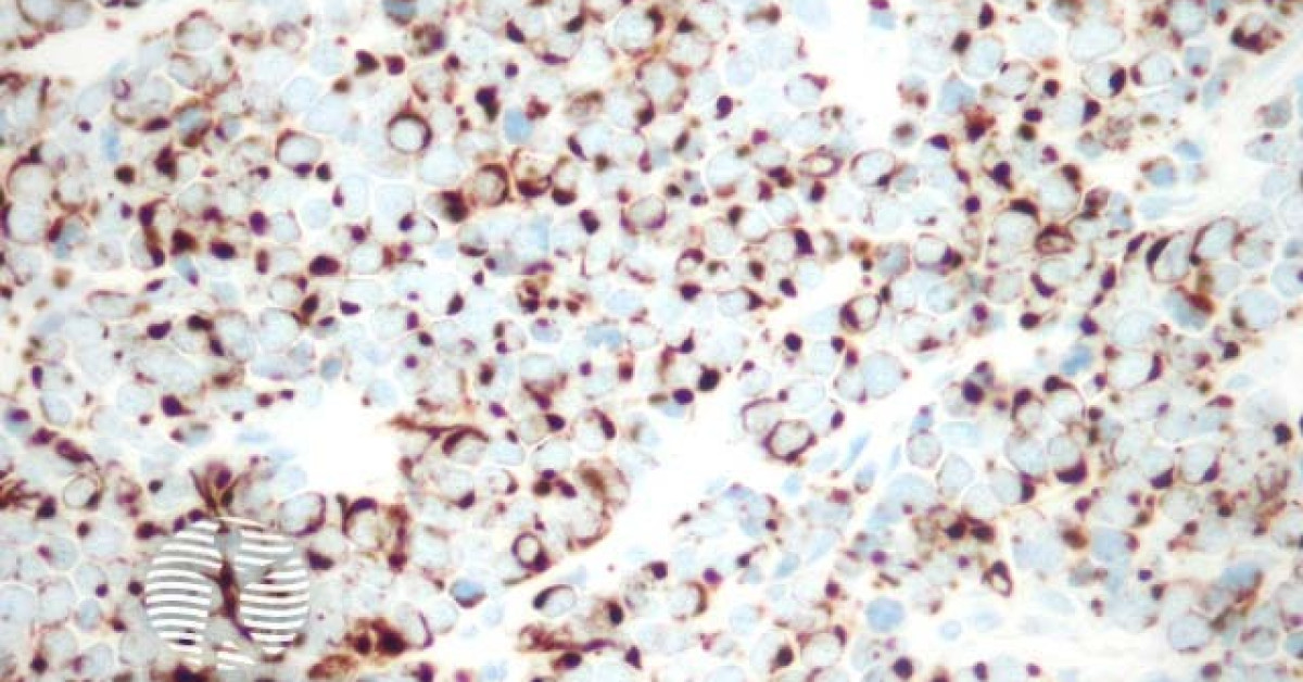 CD20+ in Merkel cell carcinoma pathology image