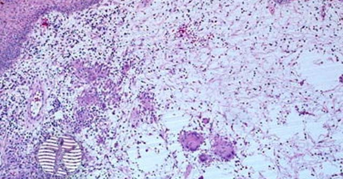 Metastatic Crohn disease pathology image