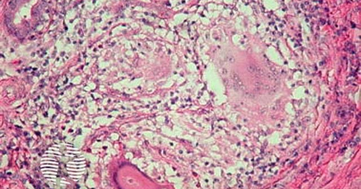Metastatic Crohn disease pathology image