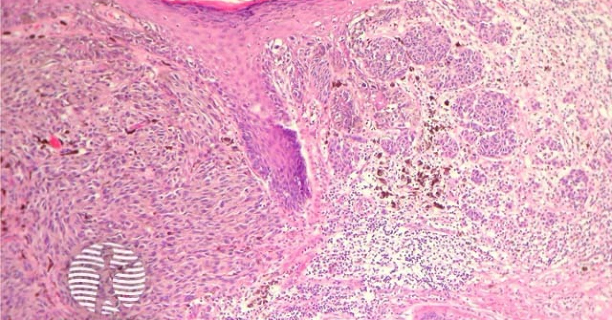 Melanoma pathology: superficial spreading melanoma, vertical growth ...