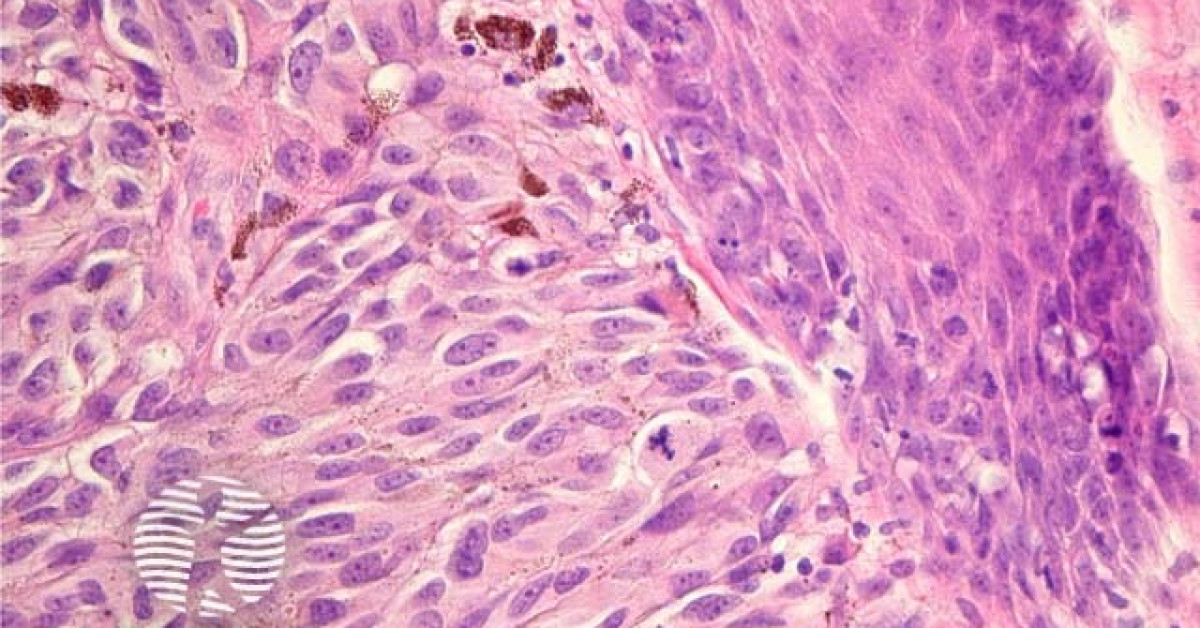 Melanoma pathology: superficial spreading melanoma, vertical growth ...