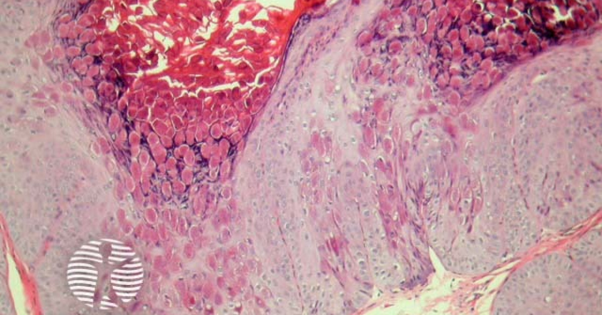 Molluscum contagiosum pathology image Molluscum contagiosum pathology image
