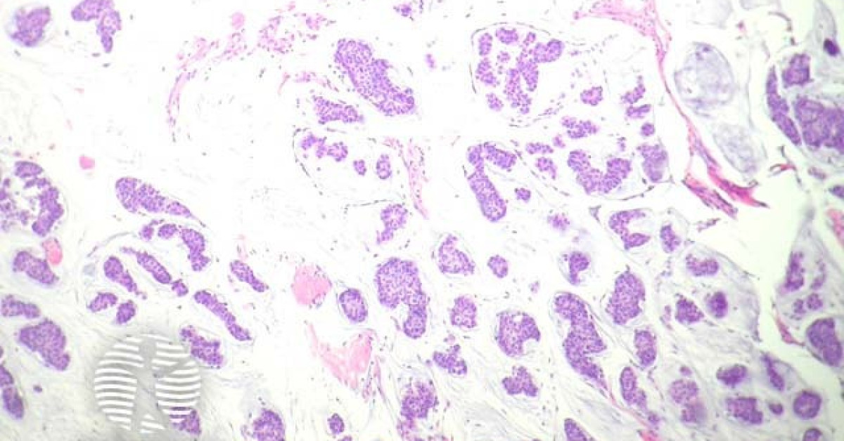 Mucinous carcinoma pathology image