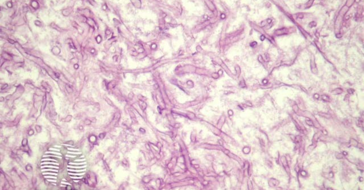 Mucormycosis pathology image