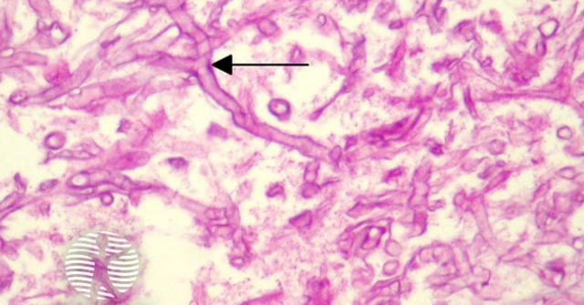 Mucormycosis pathology image