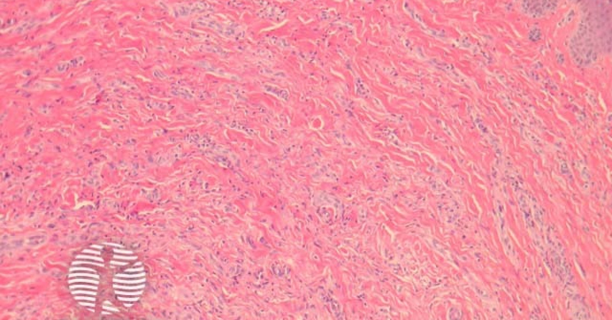 Multinucleate cell angiohistiocytoma pathology image
