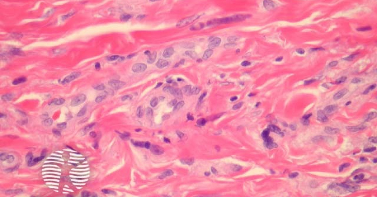 Multinucleate cell angiohistiocytoma pathology image