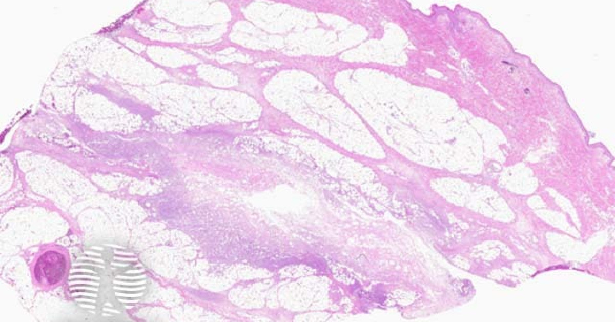 Necrotising fasciitis pathology image