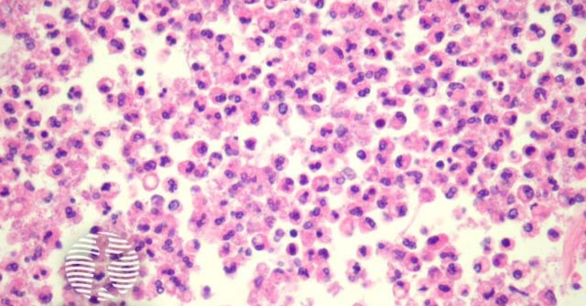 Necrotising fasciitis pathology image