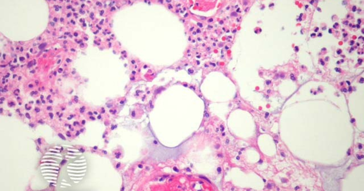 Necrotising fasciitis pathology image