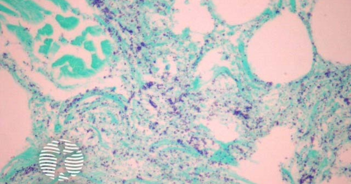 Necrotising fasciitis pathology image