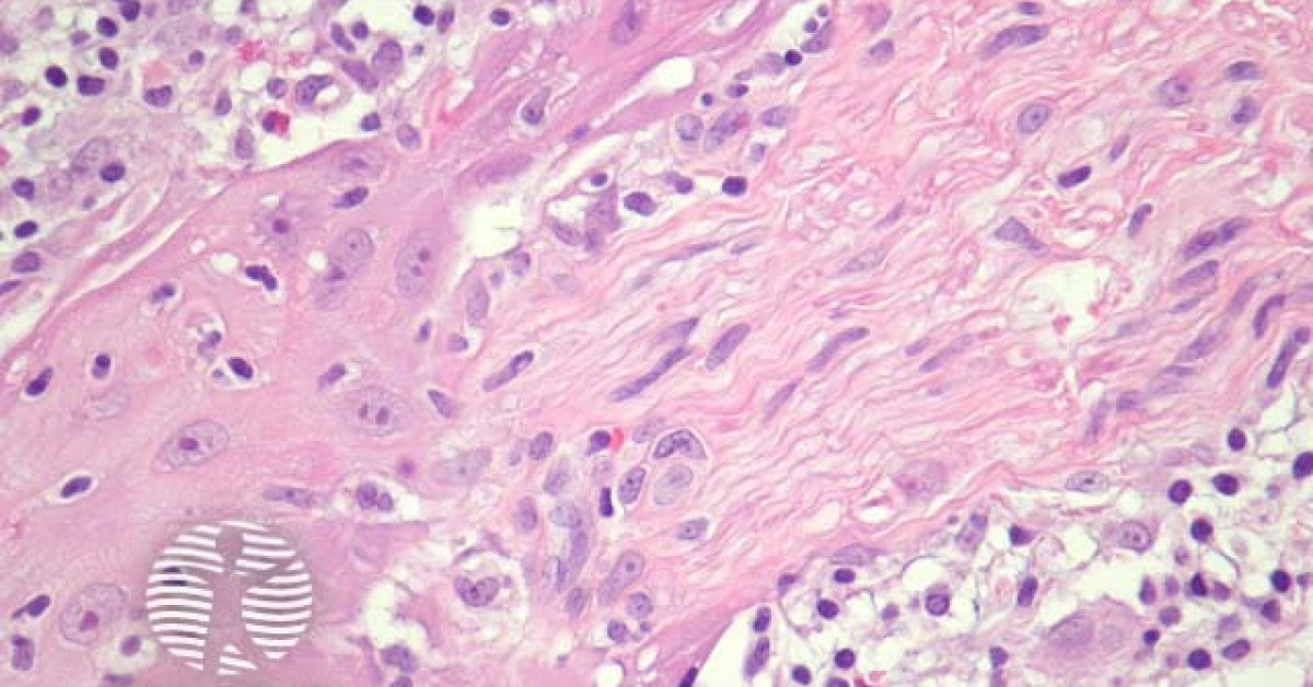 Squamous cell carcinoma pathology image