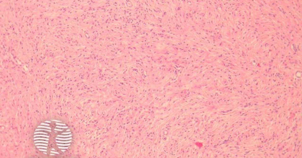 Neurofibroma pathology image