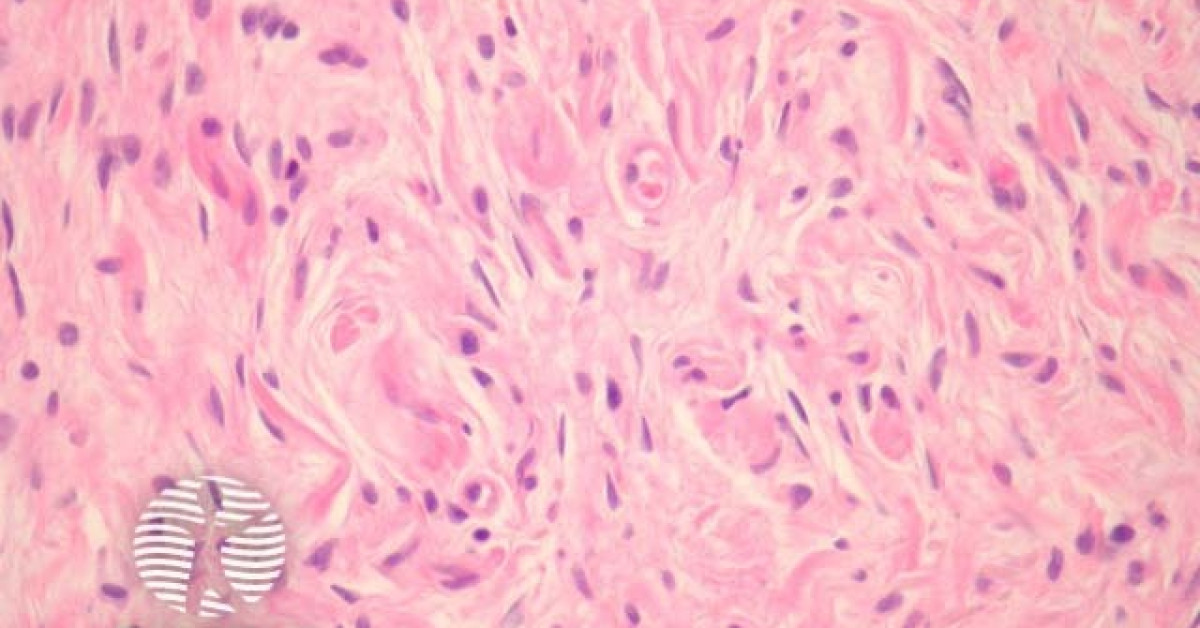 Neurofibroma pathology image