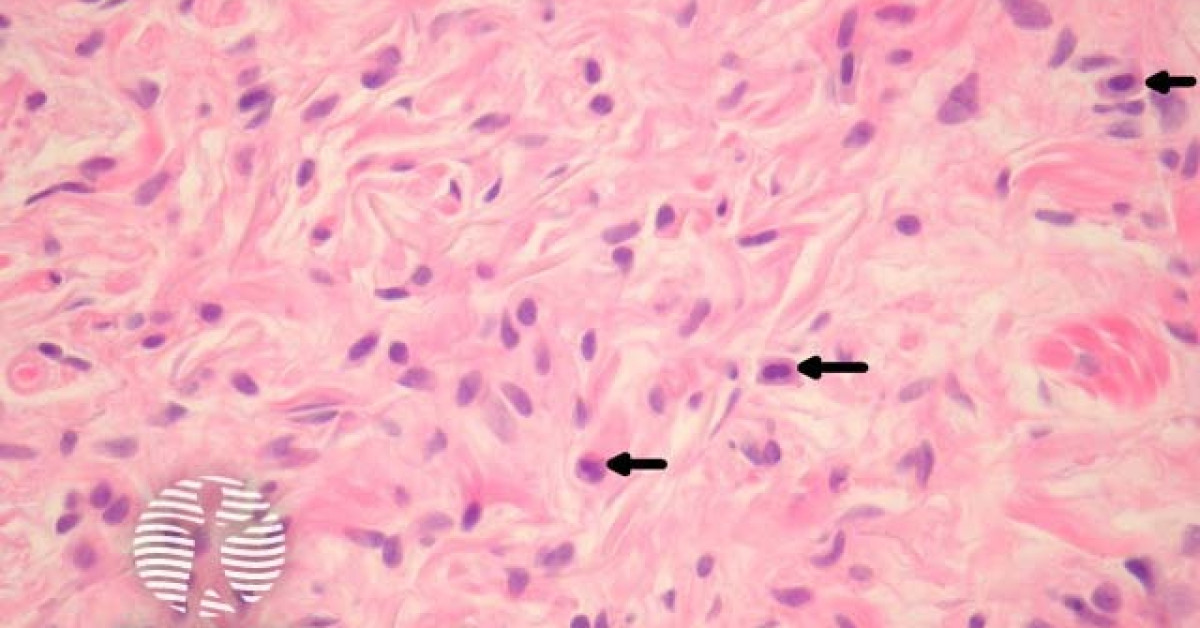 Neurofibroma pathology image