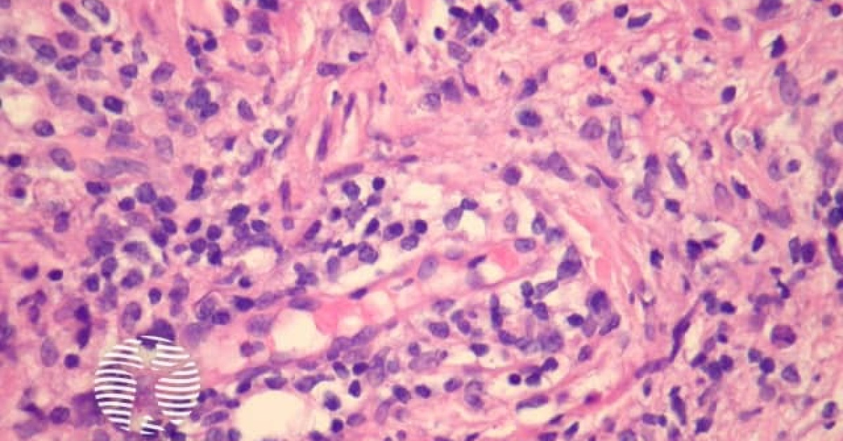Extranodal NK/T cell lymphoma, nasal type pathology image