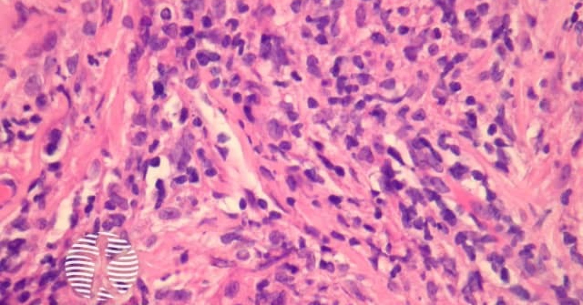 Extranodal NK/T cell lymphoma, nasal type pathology image