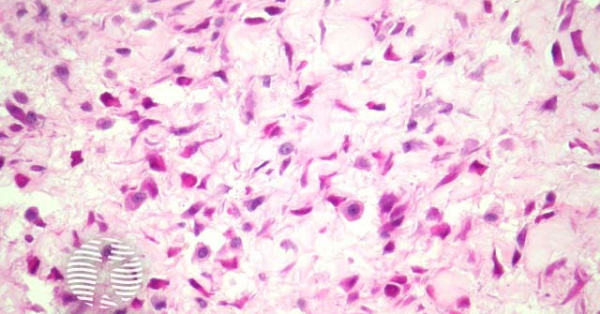 Nodular fasciitis pathology image