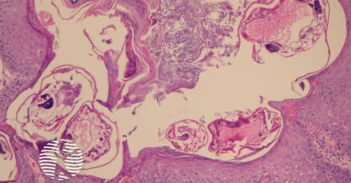 Crusted scabies pathology image
