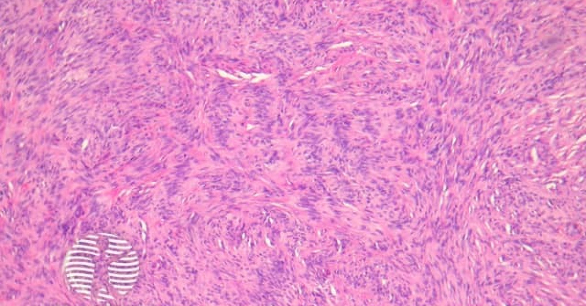 Palisading dermatofibroma pathology image