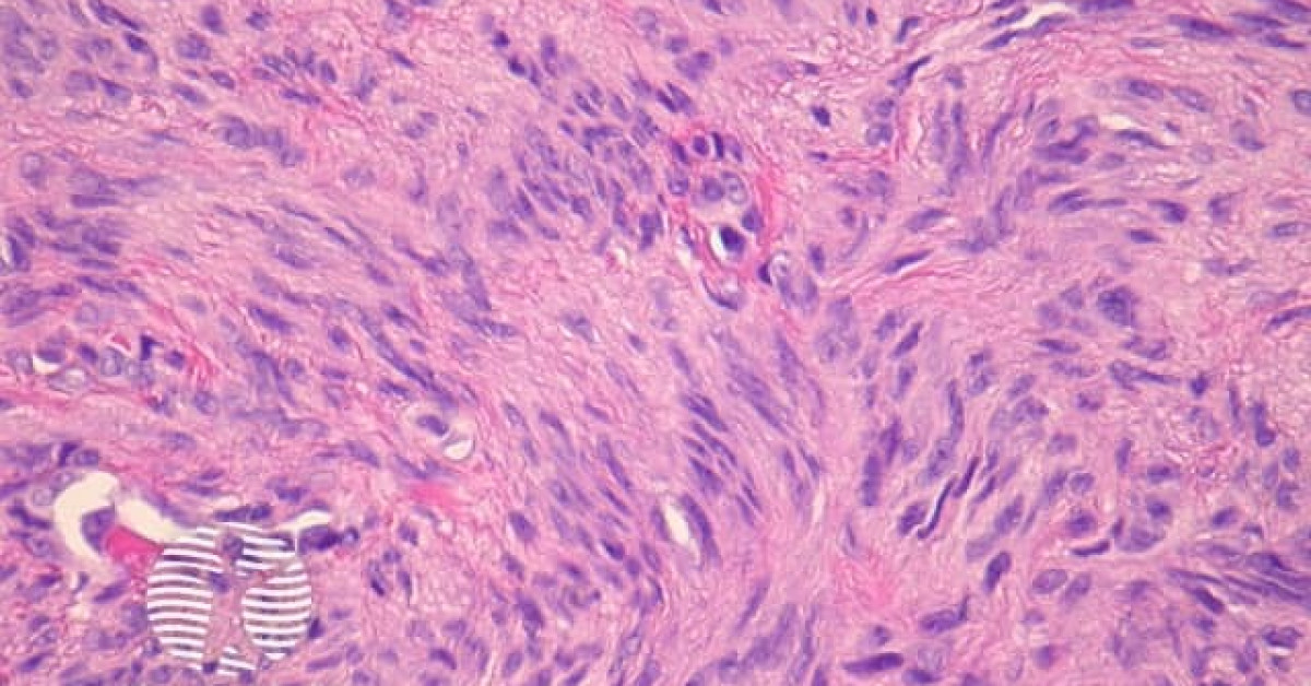 Palisading dermatofibroma pathology image