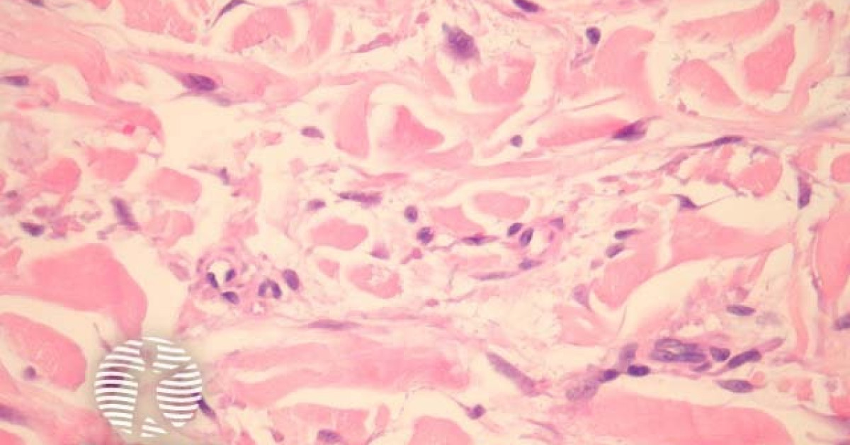 Papular mucinosis pathology image