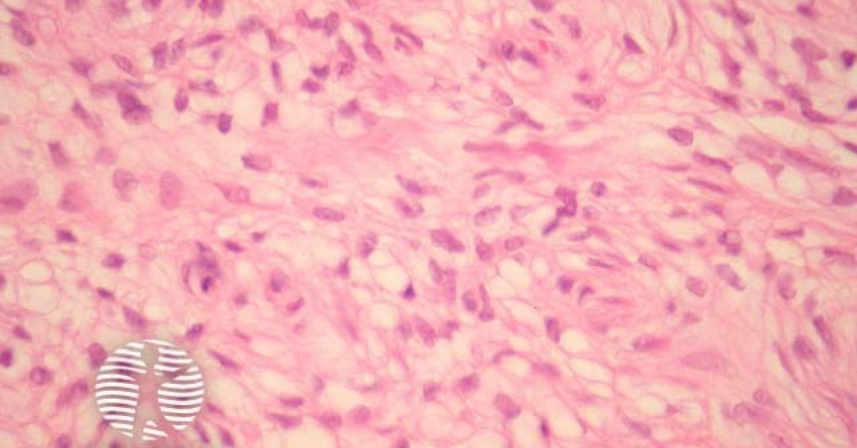 Perineurioma pathology image