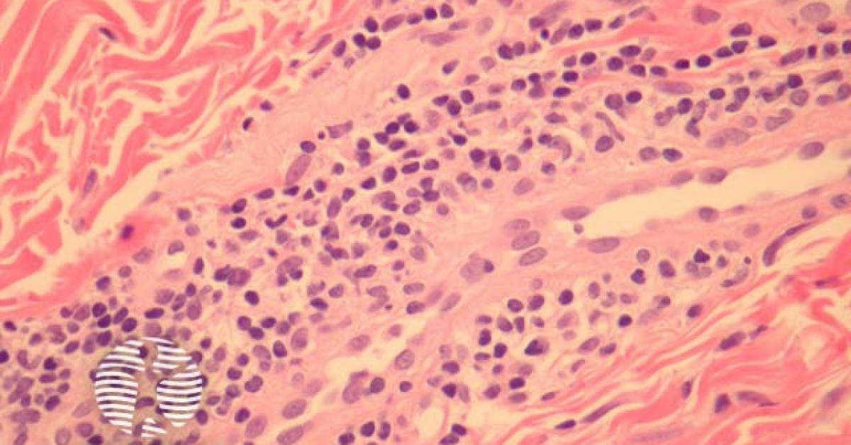Perniosis pathology image