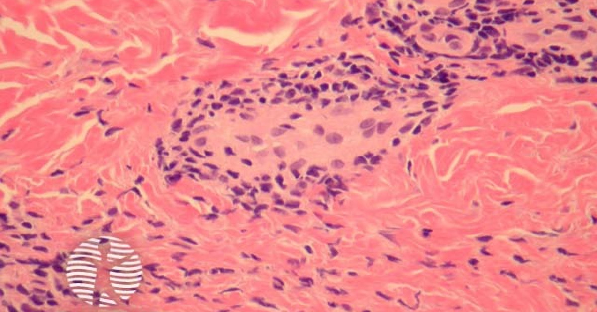 Perniosis pathology image