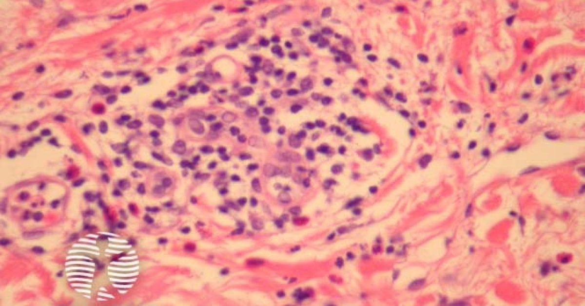 DermNet® - Perniosis pathology image