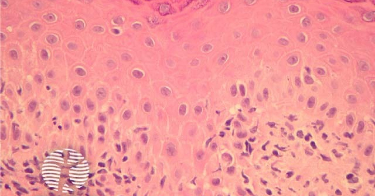 Chilblain lupus pathology image