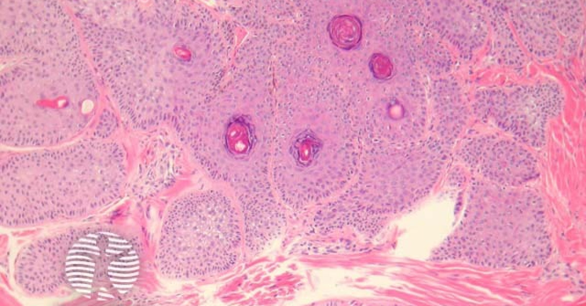 Pilar sheath acanthoma pathology image