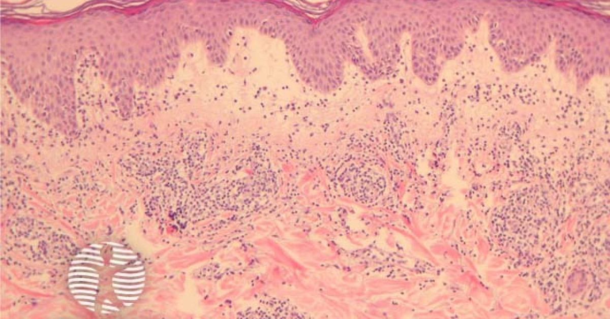 Polymorphic light eruption pathology image
