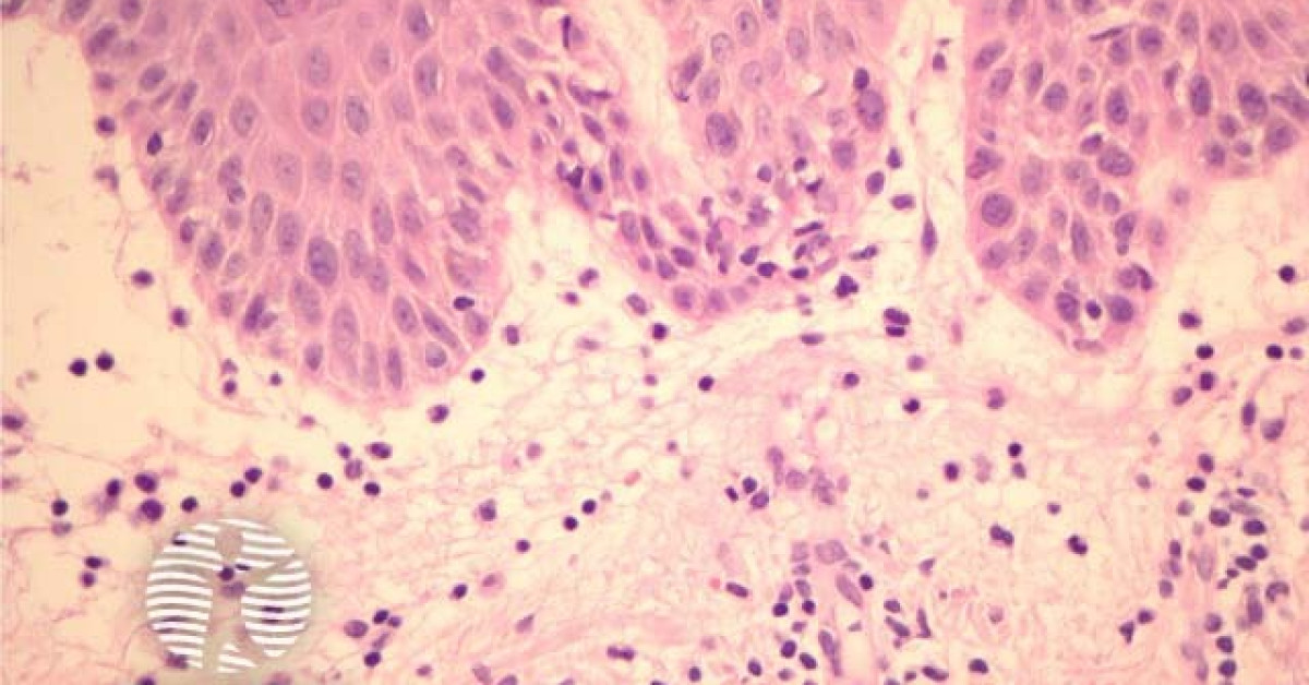 Polymorphic light eruption pathology image