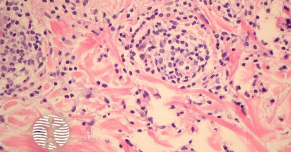 Polymorphic light eruption pathology image