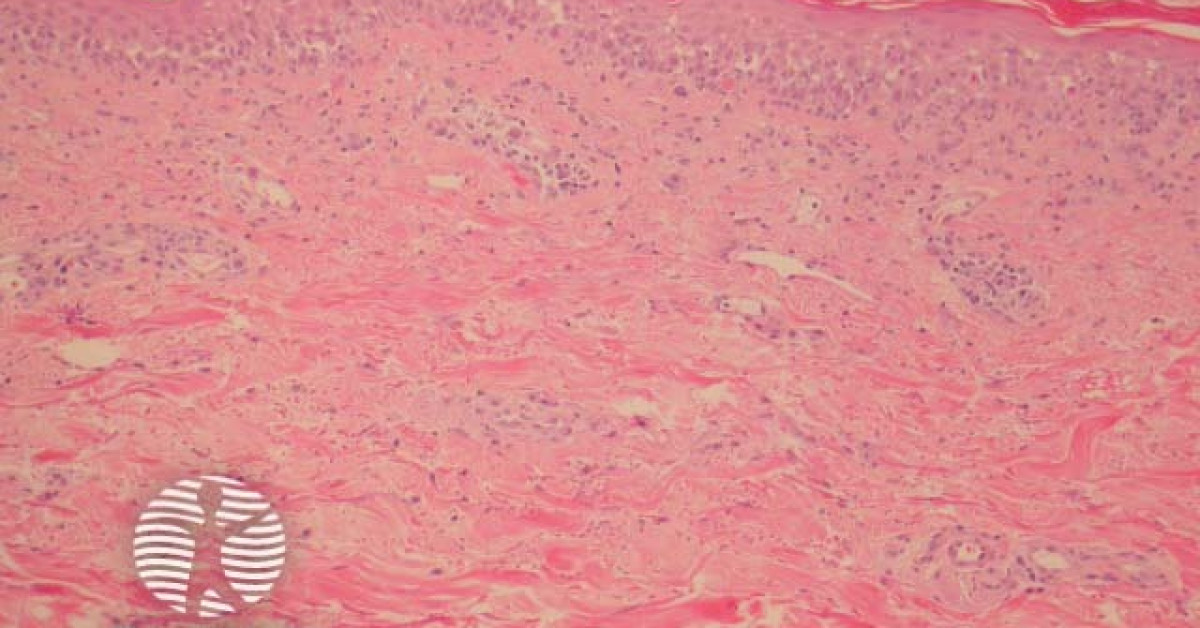 Paraneoplastic pemphigus pathology image