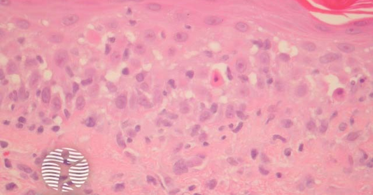DermNet® - Paraneoplastic pemphigus pathology image