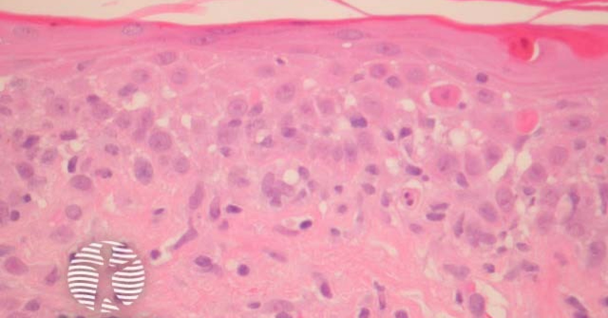 Paraneoplastic pemphigus pathology image