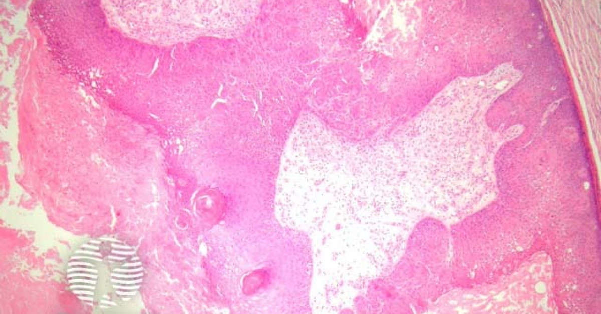 Proliferating epidermoid cyst pathology image