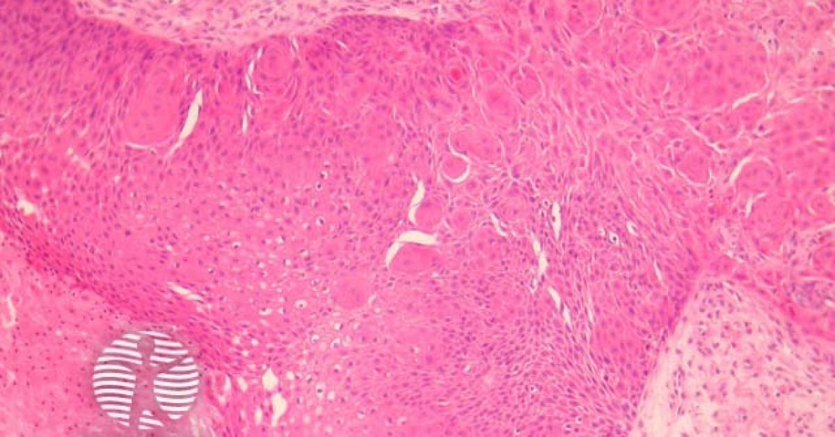 Proliferating Epidermoid Cyst Pathology Image