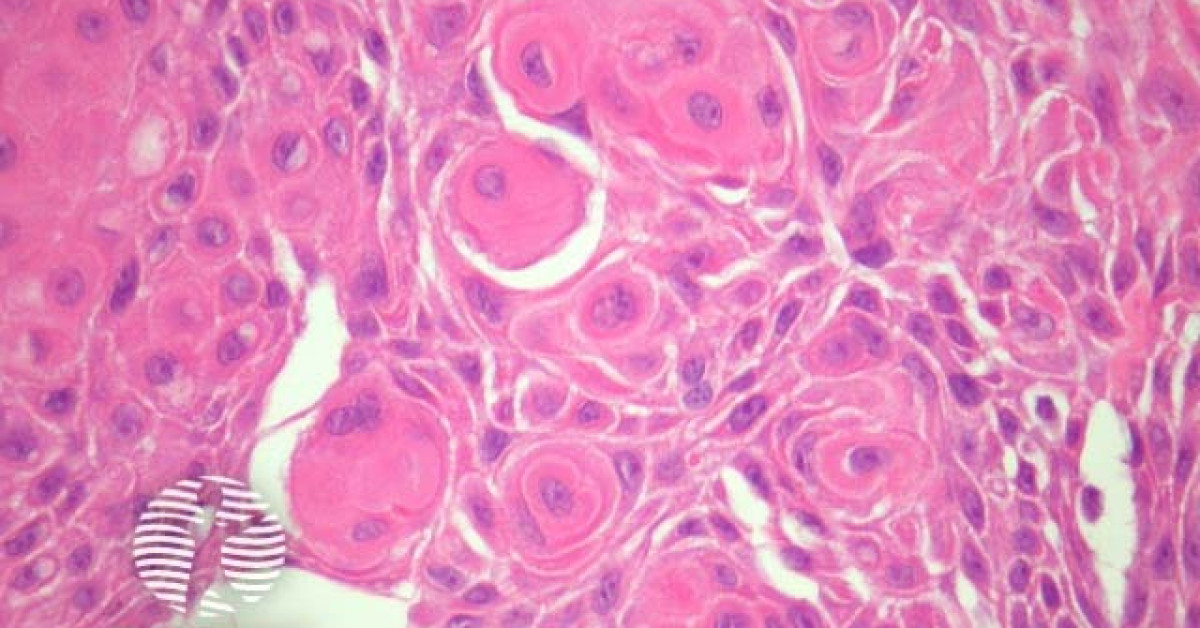 Proliferating epidermoid cyst pathology image
