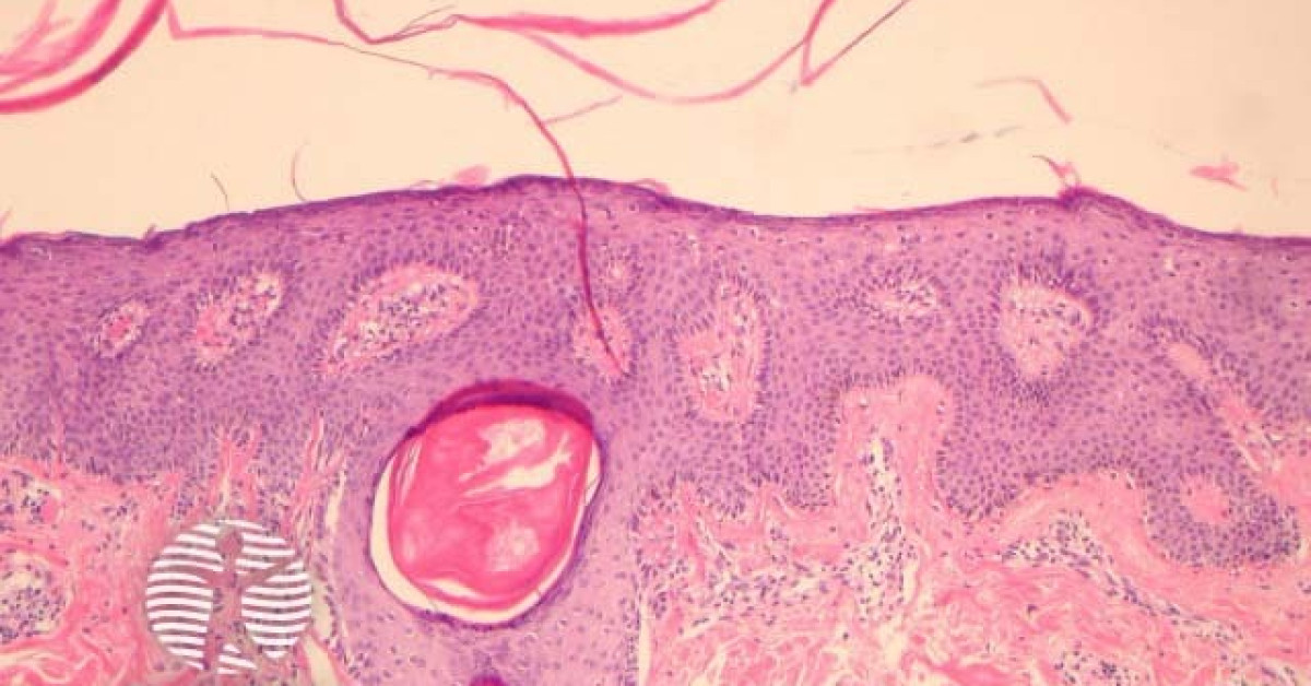 Pityriasis rubra pilaris pathology image