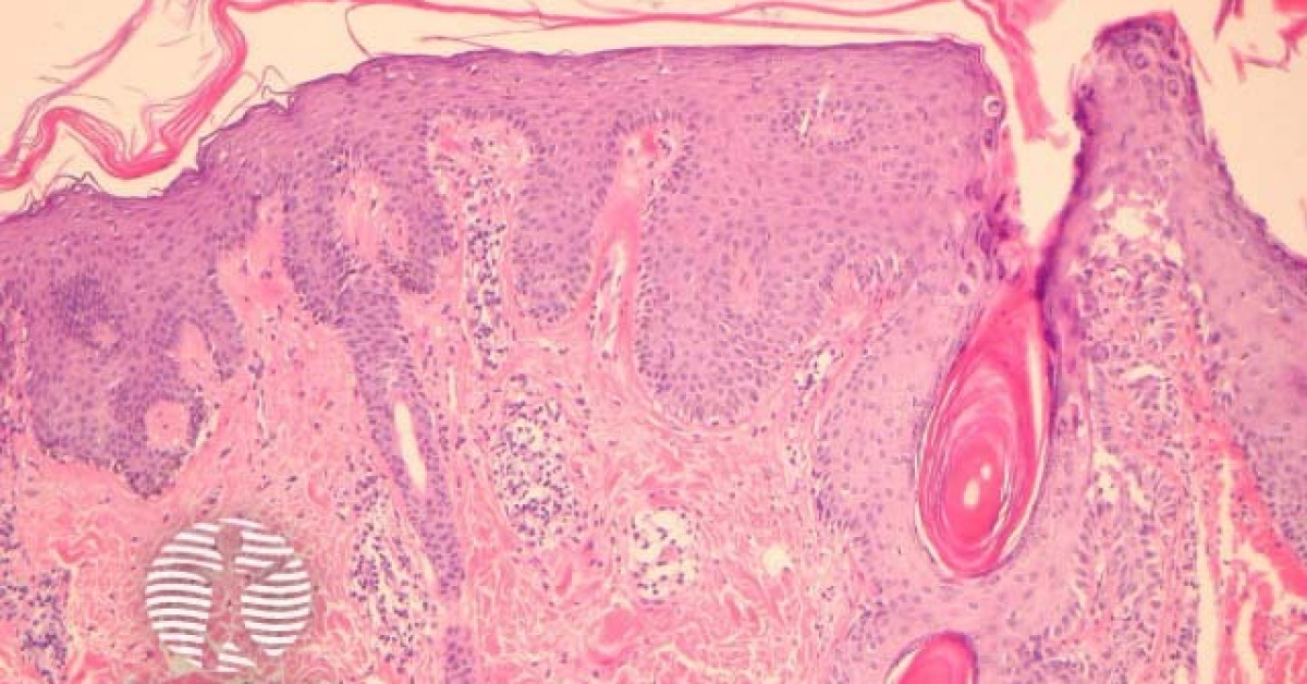 Pityriasis rubra pilaris pathology image