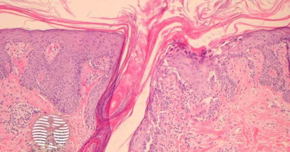 Pityriasis rubra pilaris pathology image
