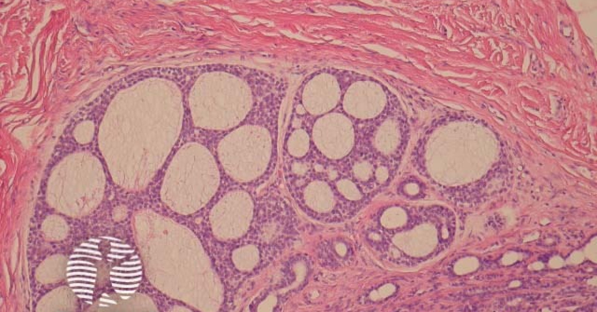 Polymorphous sweat gland carcinoma pathology image