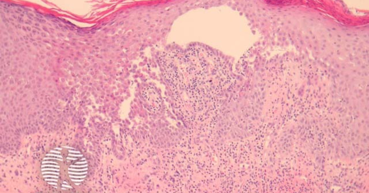 Pemphigus vulgaris pathology image