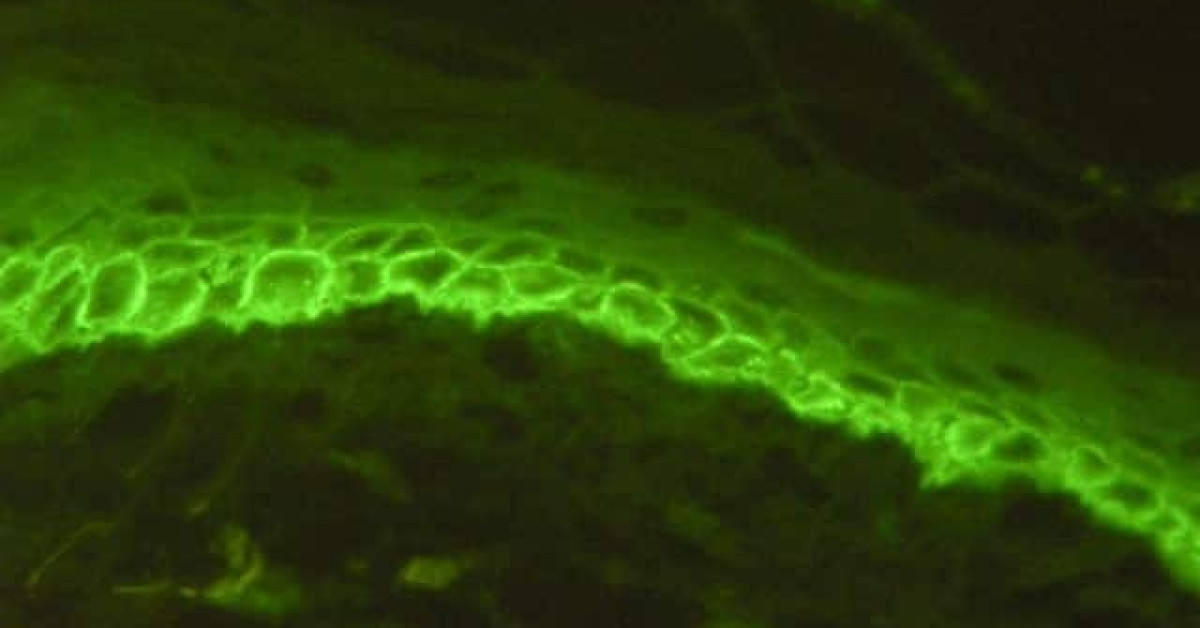 Pemphigus vulgaris pathology image